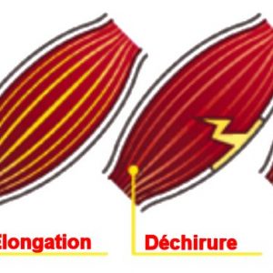 Le claquage musculaire - Qu'est ce que c'est ? - Actu Santé Fenua