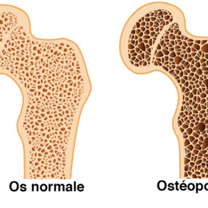 Comprendre l'ostéoporose pour mieux préserver son capital osseux - Actu ...